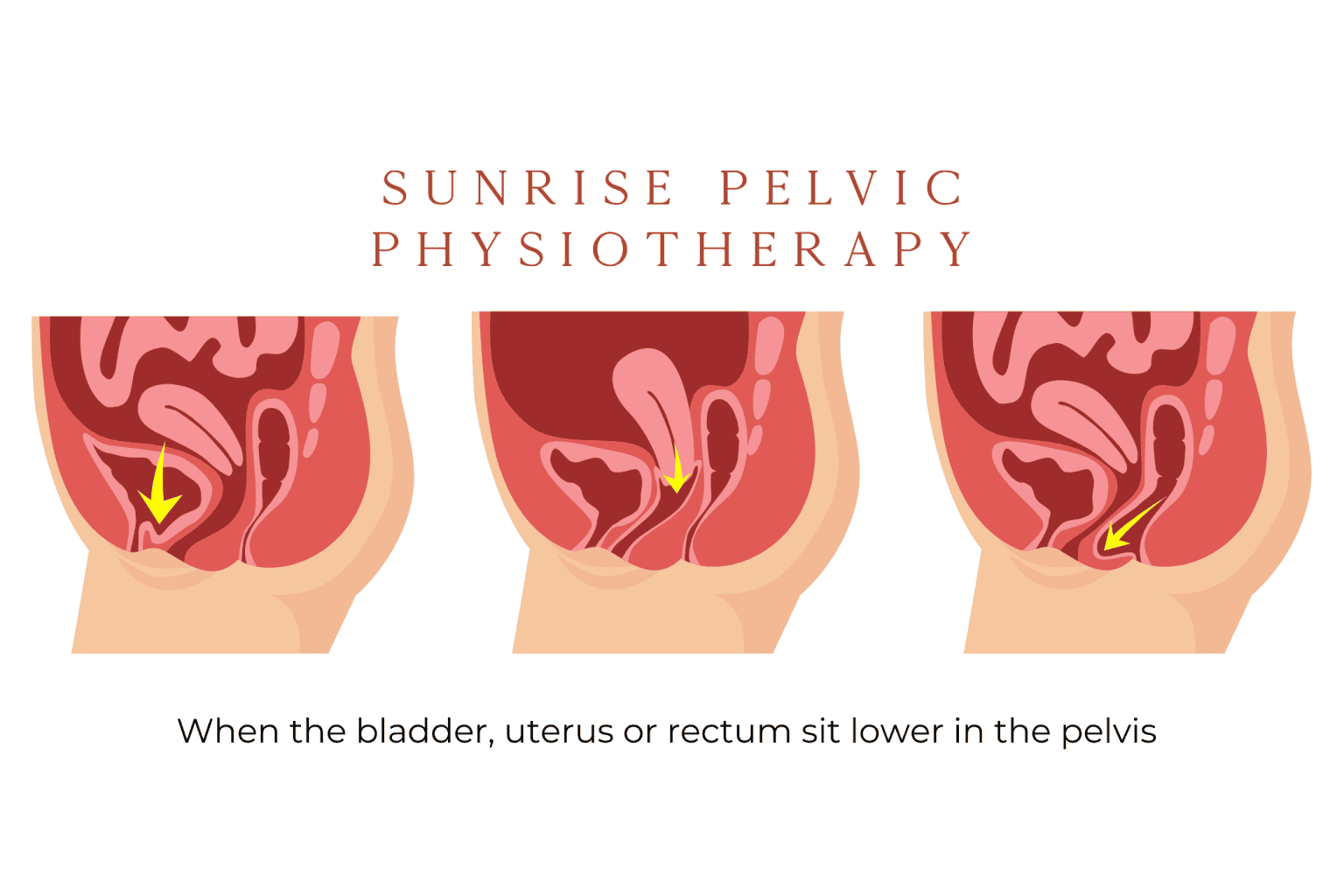 Understanding Pelvic Organ Prolapse – And How Pelvic Physiotherapy Can Help